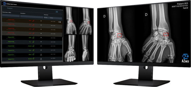 AZMed Rayvolve za prepoznavanje fraktur - BRAINTEC d.o.o.